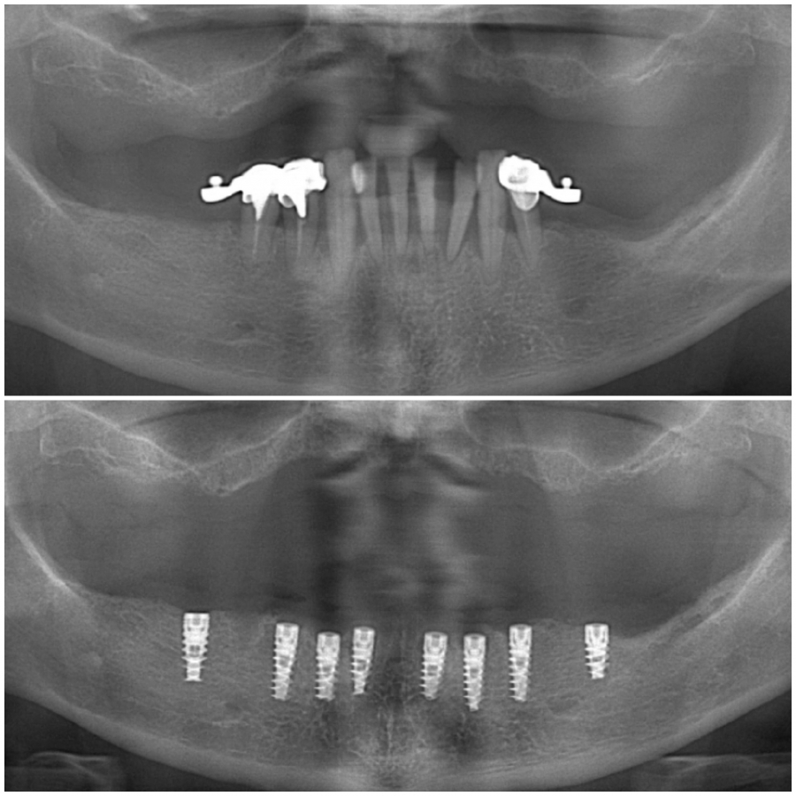 Punti metaloceramice pe implanturi Alpha Bio
